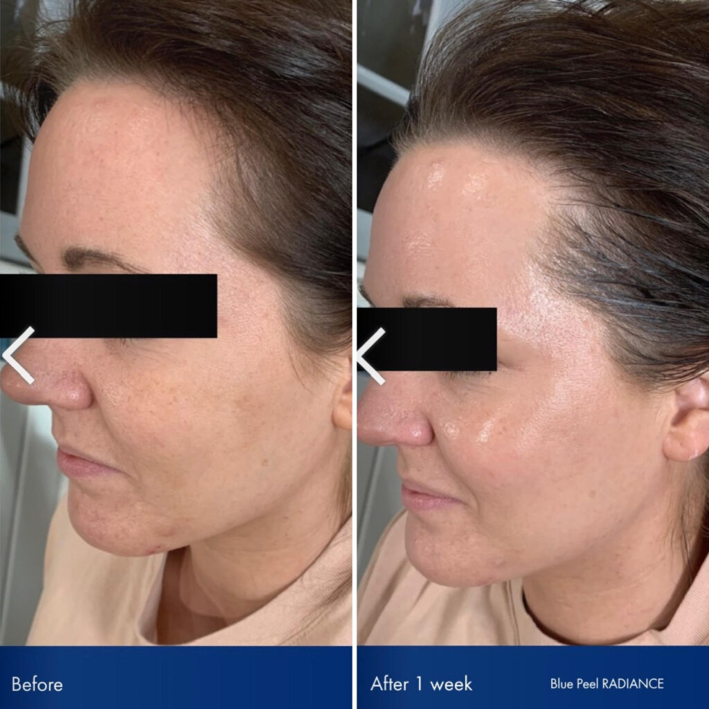 Chemical peels by Obagi: beautiful results instantly